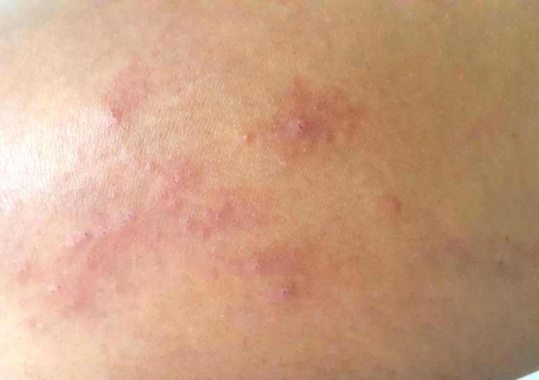 ผื่นคันเวลาไปดำน้ำหรือเล่นน้ำทะเล (Sea Bather's Eruption หรือ "แตนทะเล ...